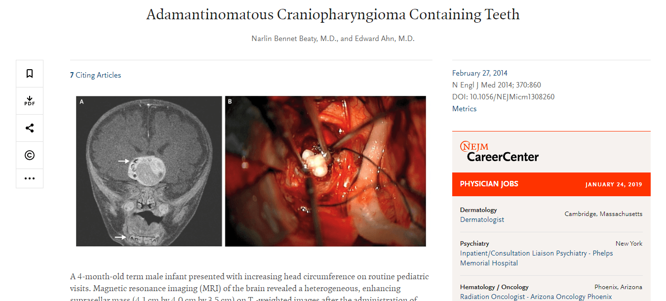 Teratoma Tumor The Demonic Mass That Grows Teeth Eyes Feet And